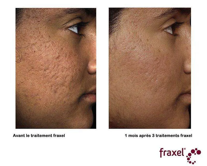 Laser Fraxel révolutionnaire en dermatologie - Lazeo Médical